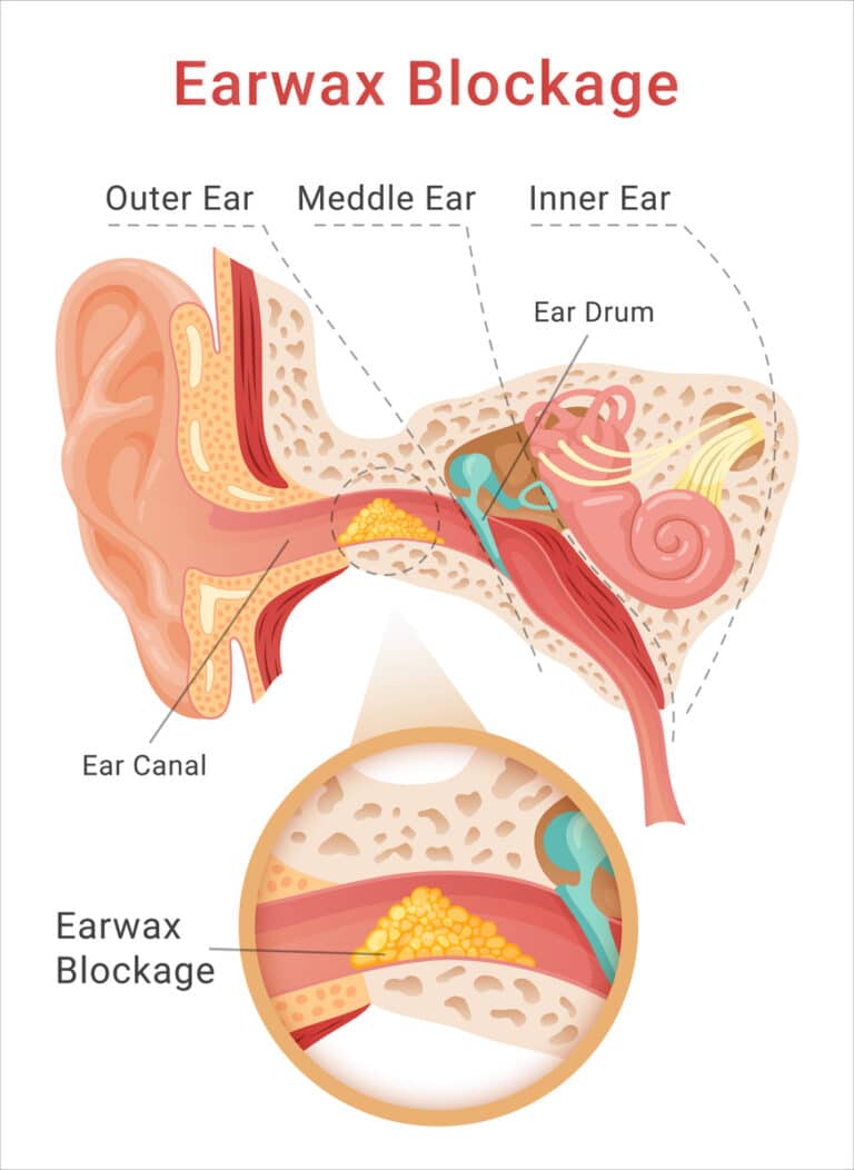 The Essential Guide to Safe Earwax Removal and Why It Matters | Alpine ...