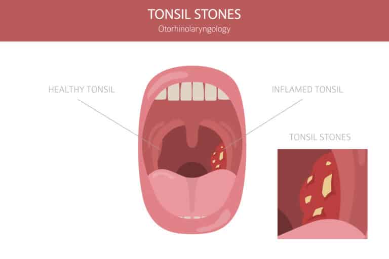 What To Know About Tonsil Stone Removal | Alpine Ear, Nose & Throat | Blog